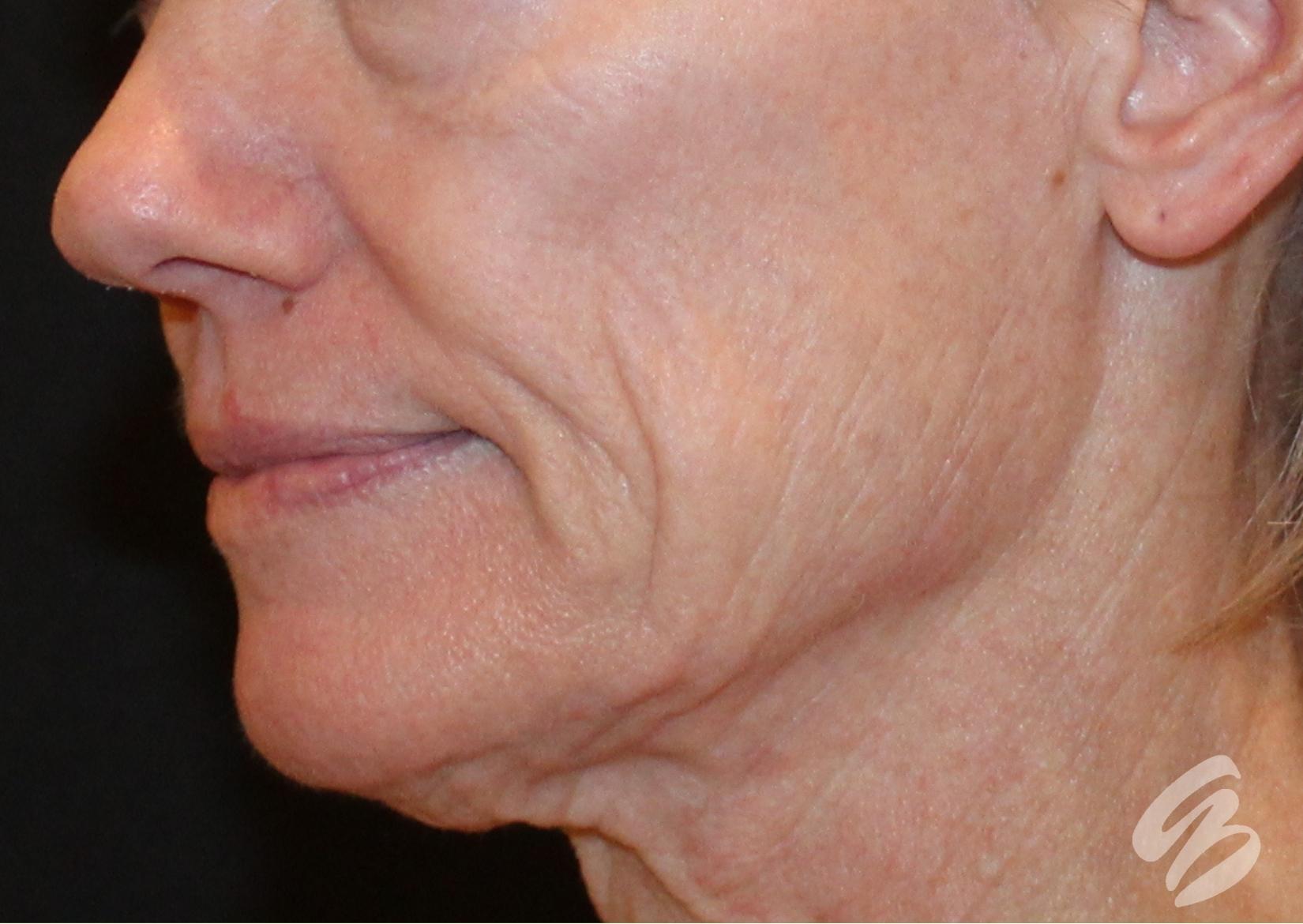 Photofacial in Cincinnati | BBL Hero & Forever Young BBL | Amy Brenner, MD